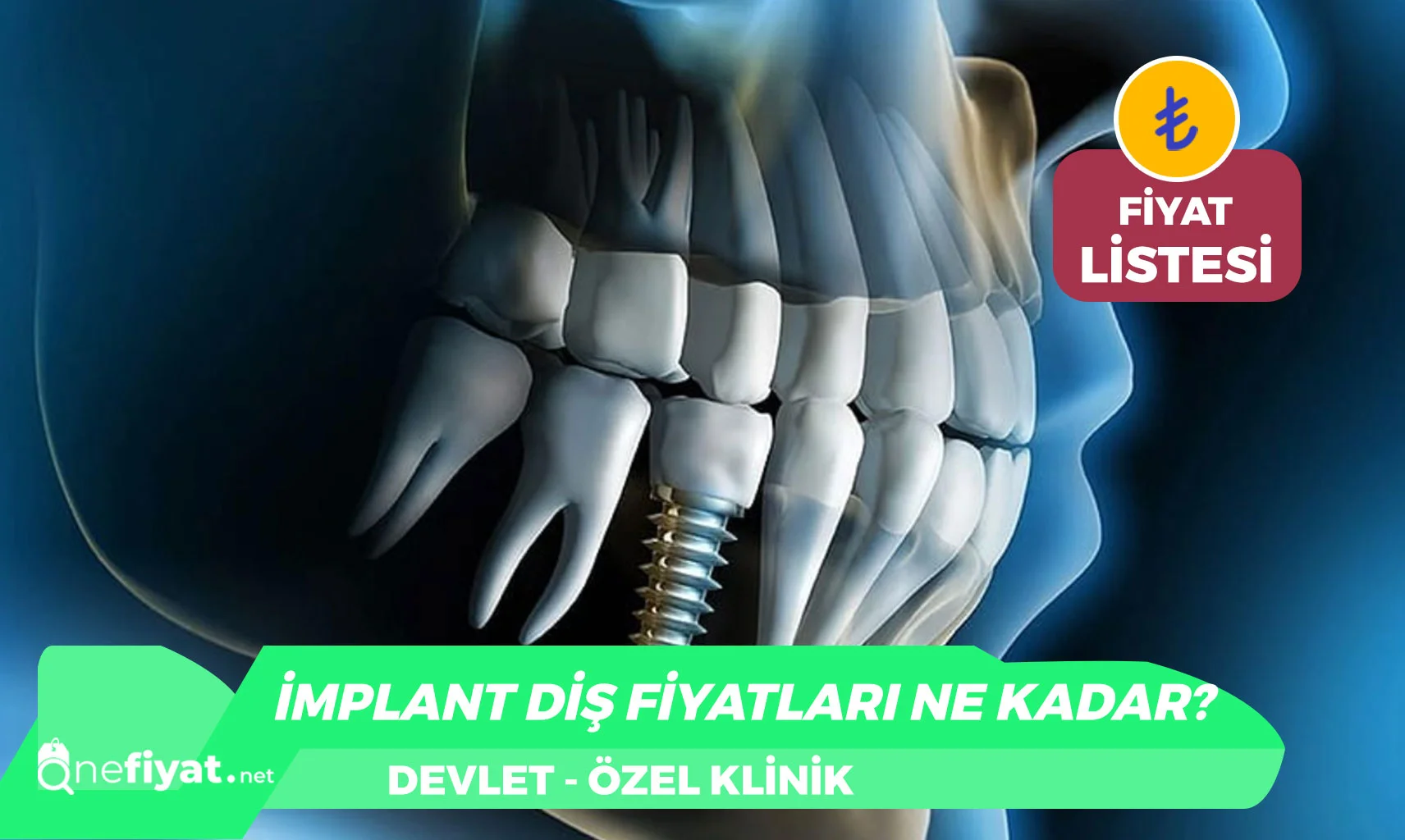 İmplant Diş Fiyatları 2024 | Özel - Devlet İmplant Fiyatları