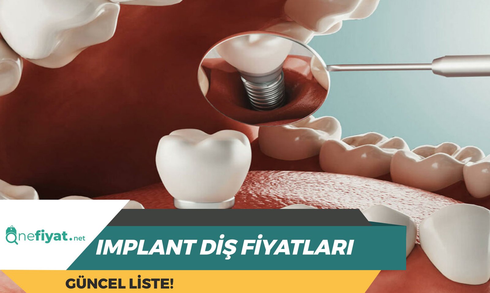 İmplant Diş Fiyatları 2024 | Özel - Devlet İmplant Fiyatları